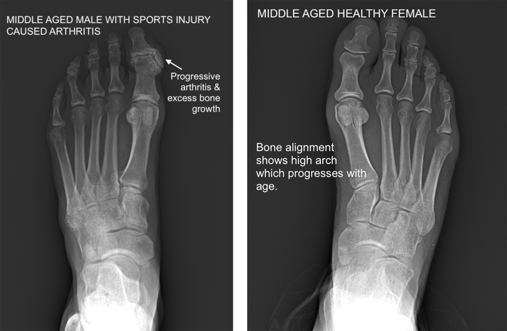 Your Aging Feet Part I: Diagnosing Age Related Changes - Align Foot & Ankle