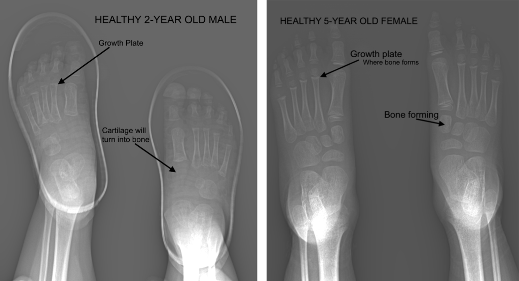 Your Aging Feet Part I: Diagnosing Age Related Changes - Align Foot & Ankle
