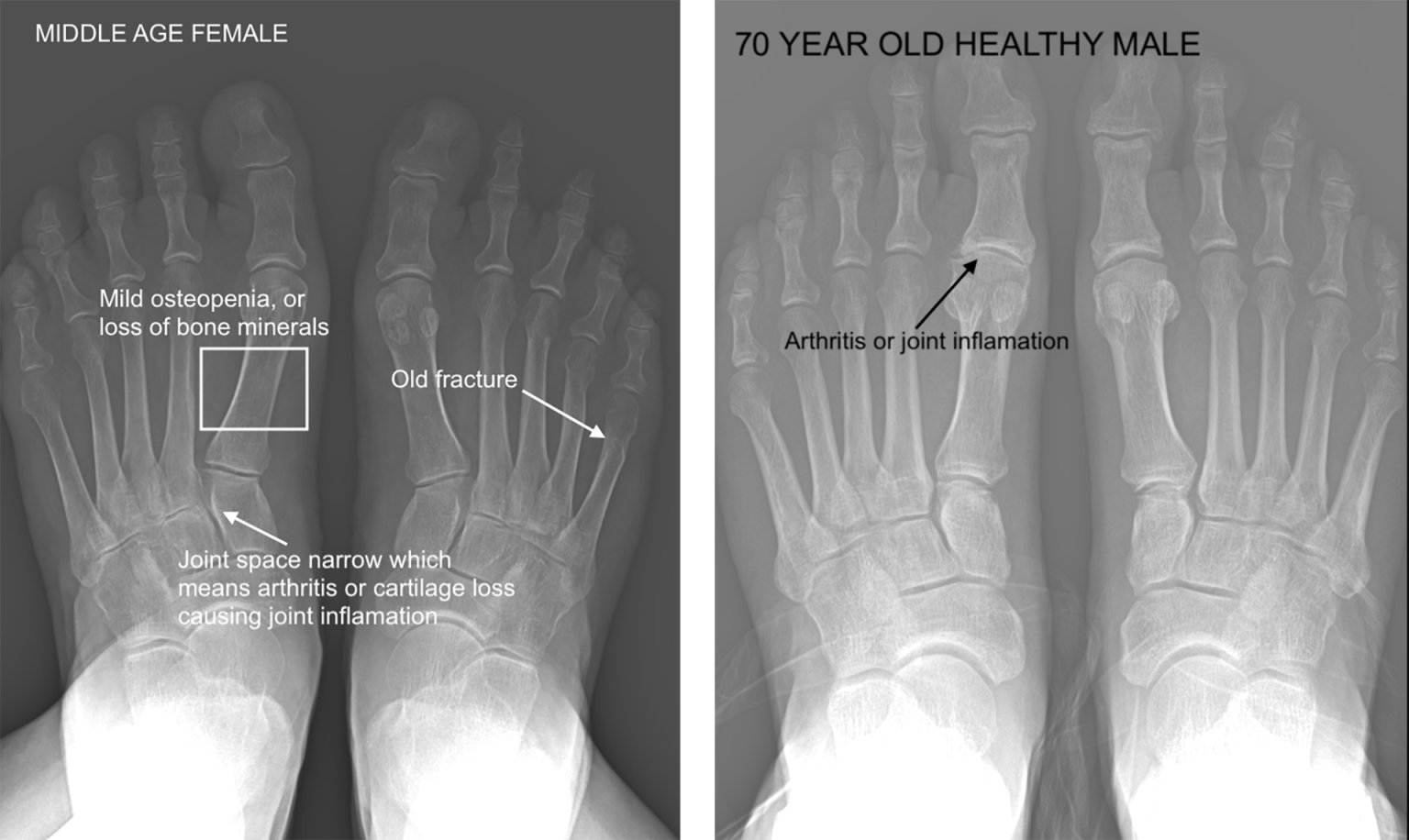 Your Aging Feet Part I: Diagnosing Age Related Changes - Align Foot & Ankle