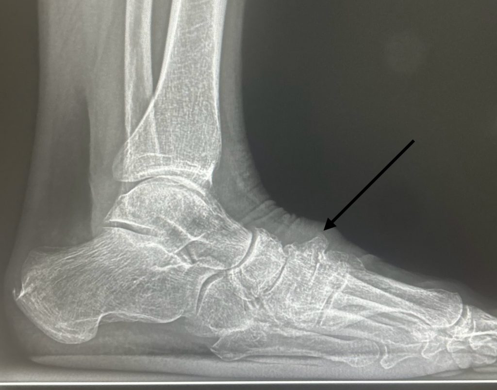Bone Spur Surgery and Prevention - Align Foot & Ankle